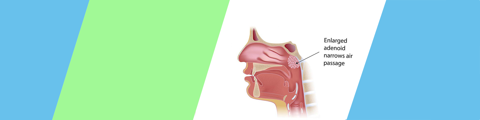 Adenoids: Symptoms, Causes, Complications, FAQ | Chord Road Hospital