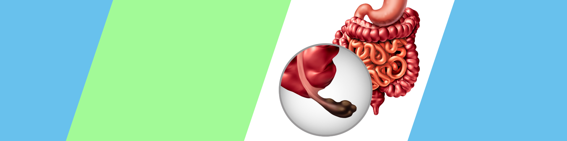 Appendix Tumors: Symptoms, Causes, Complications, FAQ | Chord Road Hospital